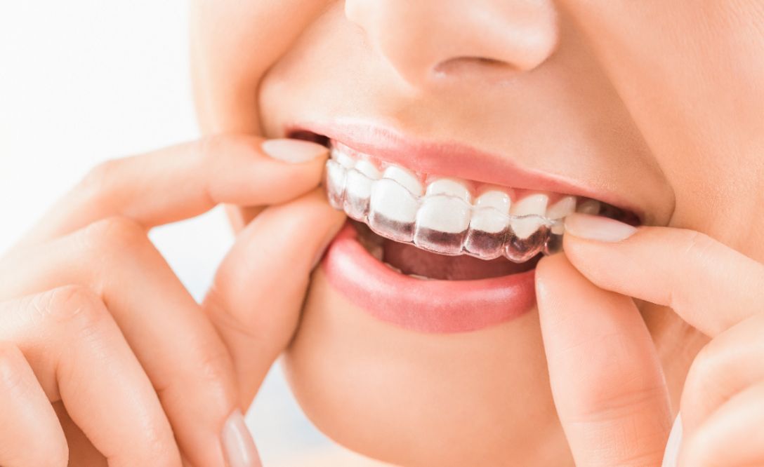 Invisalign Lite in Fort Collins, CO | Milnor Orthodontics