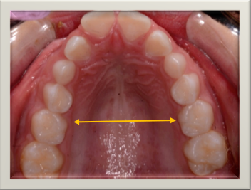 What Orthodontic Expanders Do for Children | Ft Collins Orthodontist