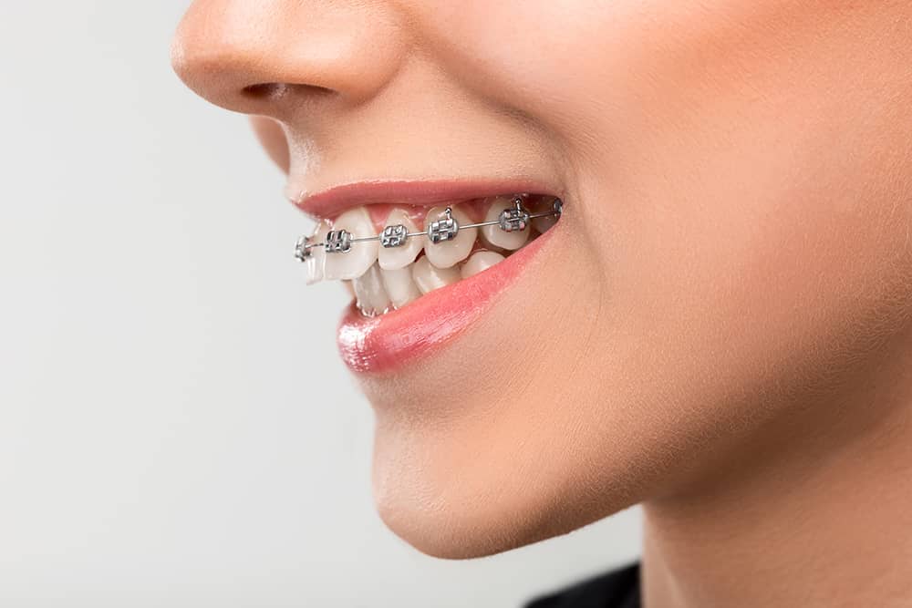 What is an Overjet? | Orthodontist in Ft. Collins